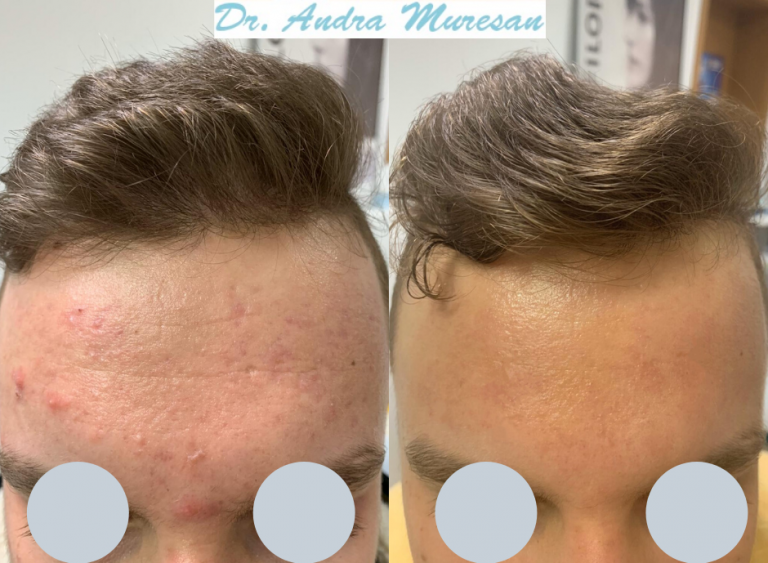 Dermatolog Acnee Timisoara – Dr. Andra Muresan | Dermatolog Timisoara
