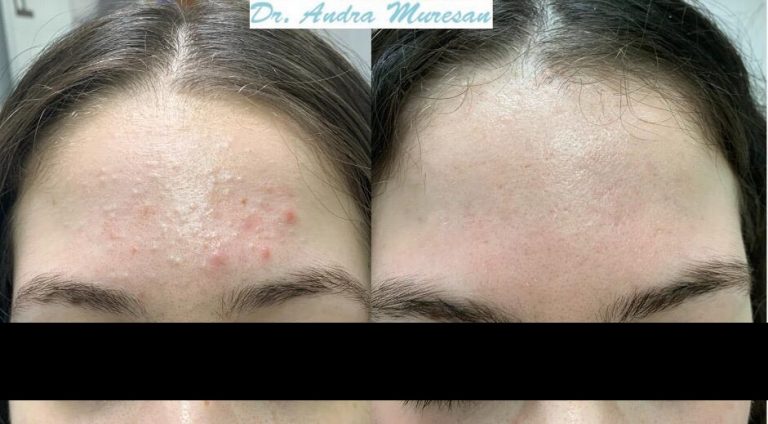 Caz Acnee Comedoniana – Dr. Andra Muresan | Dermatolog Timisoara